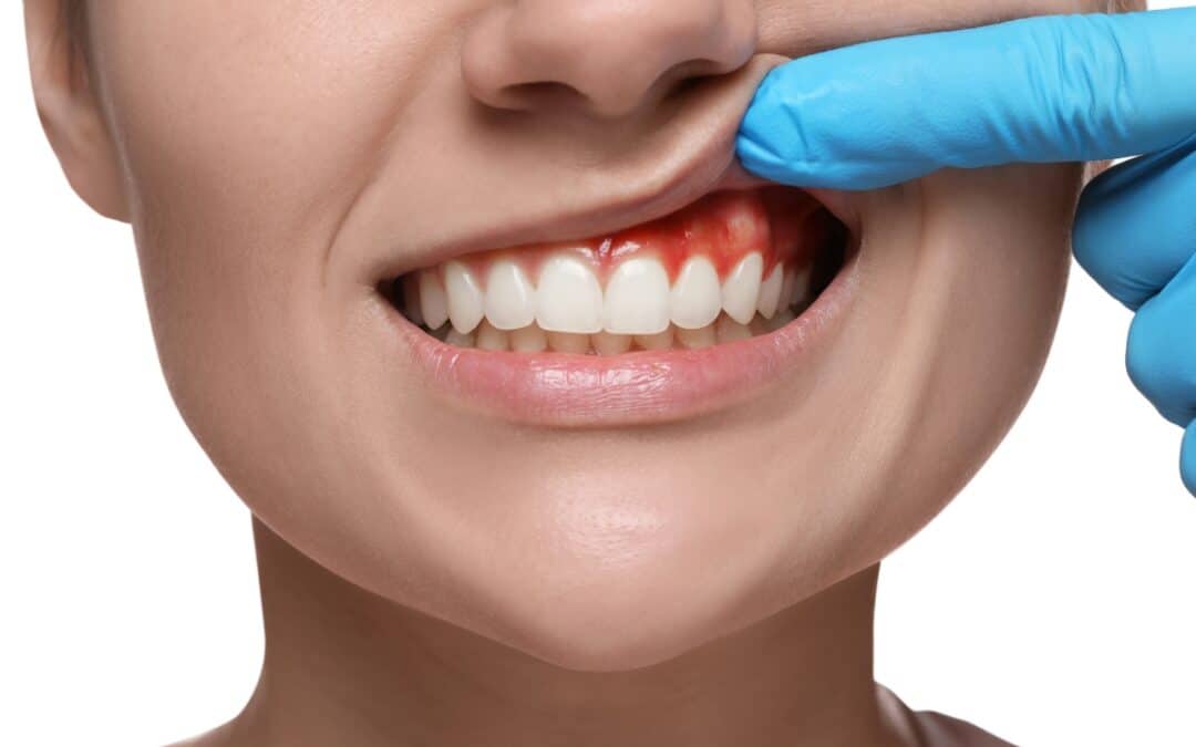 Healthy Gums: The Perfect Gift For Yourself This Christmas