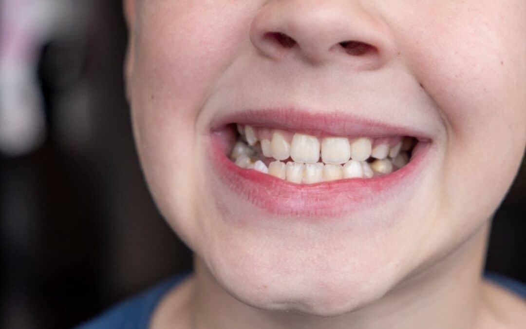 Understanding the Causes of Teeth Stains and How to Fix Them