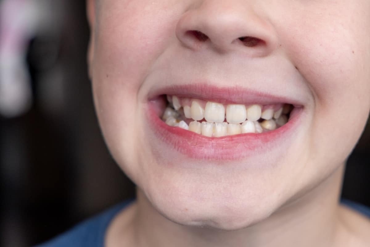 Understanding the Causes of Teeth Stains and How to Fix Them